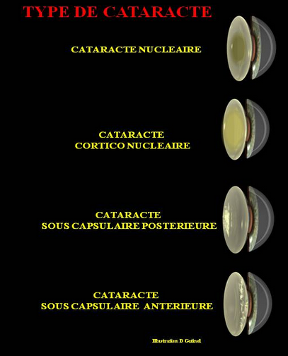 Cataractes sous-capsulaires postérieures | Dr Laurent Berthon | Lyon